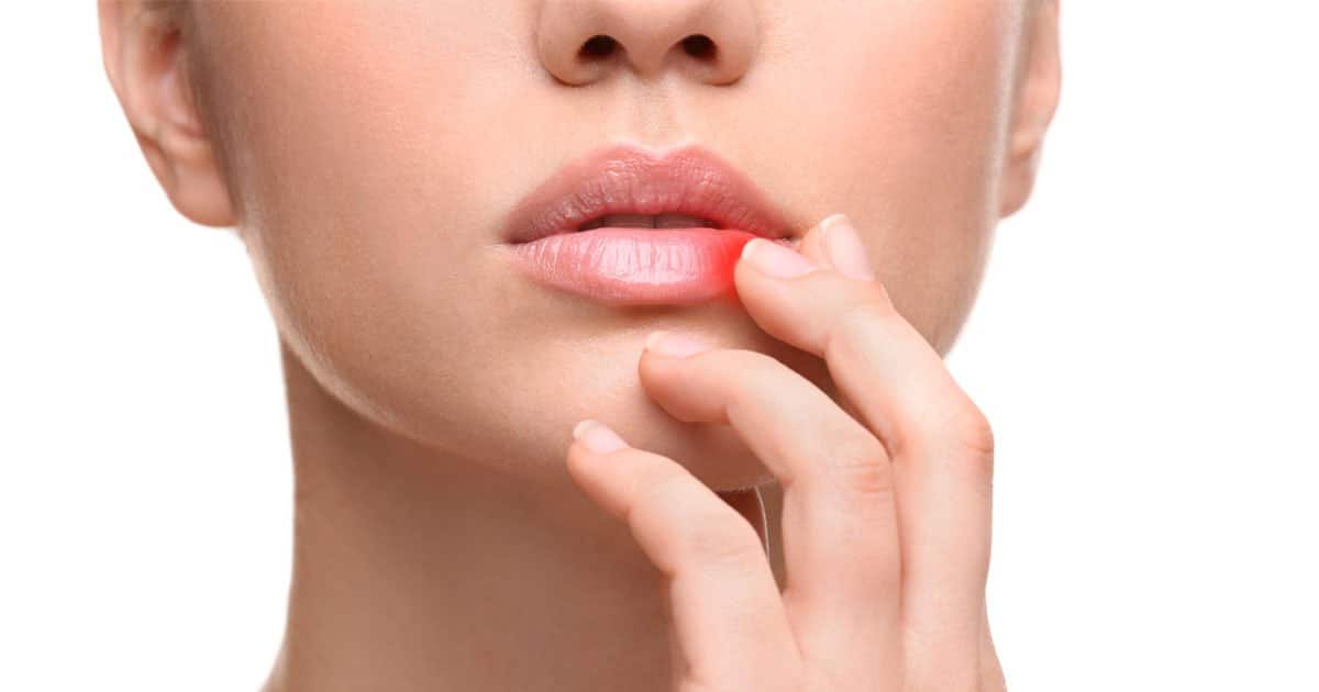 Cold Sores Solutions - Beauty of Action
