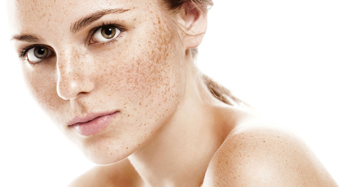 Solutions for Freckles & Dark Spots | Beauty of Action