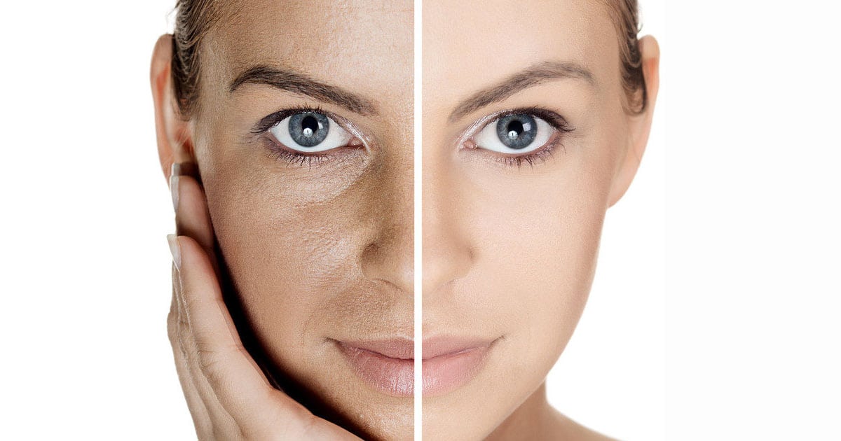 Pigmentation Solutions - Beauty of Action
